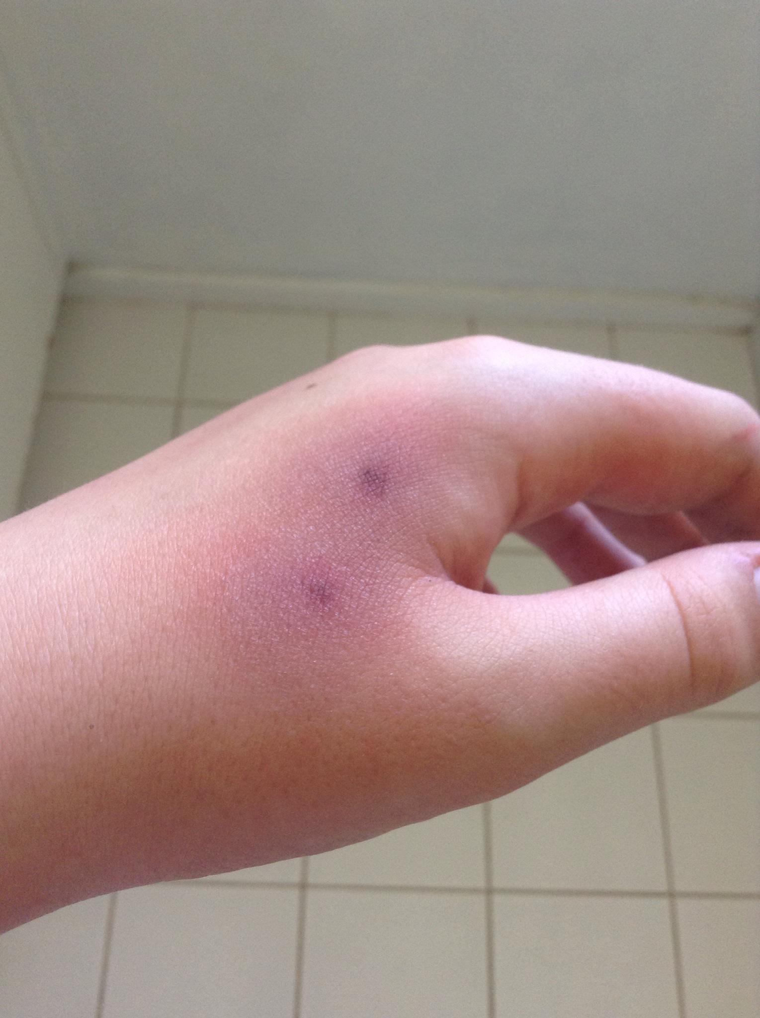 Dog Bite Finger