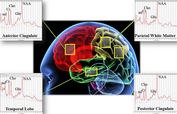 Ptsd And The Brain Diagram Complex PTSD Recovering From Child Abuse: